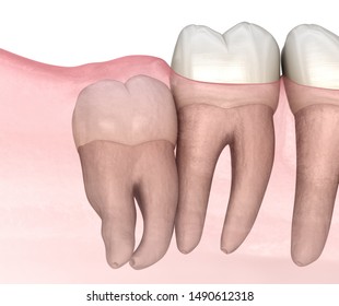Vertical Impaction Wisdom Tooth Medically Accurate Stock Illustration ...