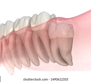 Wisdom Tooth Impaction Molar Tooth Medically Stock Illustration ...