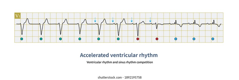 30 Ventricular Escape Images, Stock Photos & Vectors | Shutterstock