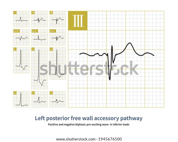 When Atrioventricular Accessory Pathway Located Back Stock Illustration ...