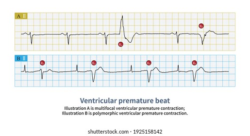 297 Ekg intervals Images, Stock Photos & Vectors | Shutterstock