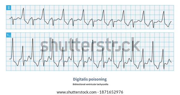 When Digitalis Poisoning Once Bidirectional Ventricular Stock ...