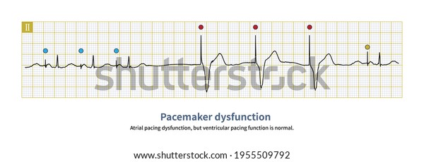 When Dual Chamber Pacemaker Fails Complex Stock Illustration 1955509792 ...