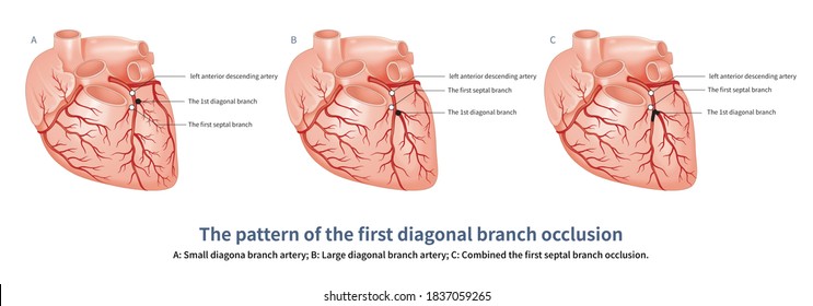 20,756 Infarct Images, Stock Photos & Vectors | Shutterstock