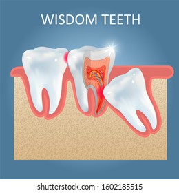 4,047 Decayed Wisdom Tooth Images, Stock Photos & Vectors | Shutterstock