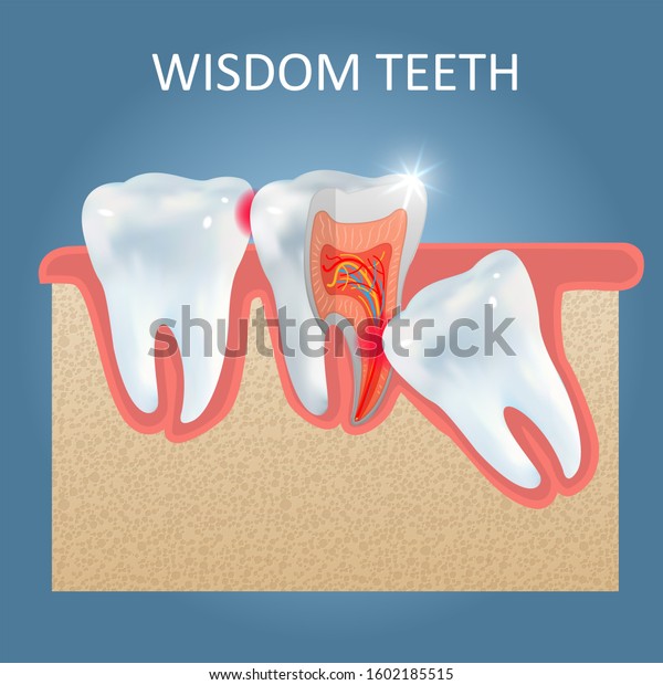 Wisdom Teeth Poster Template Realistic Illustration Stock Illustration ...