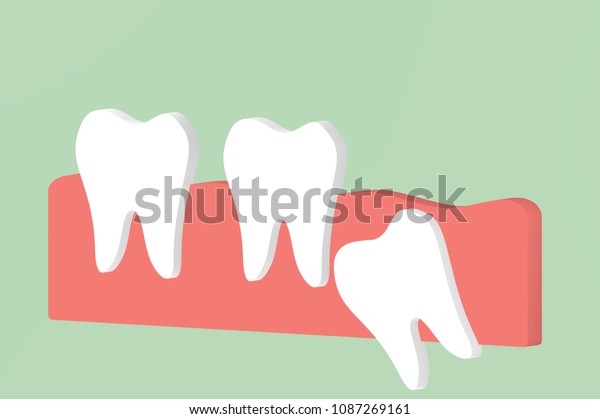 Wisdom Tooth Angular Mesial Impaction Affect Stock Illustration ...
