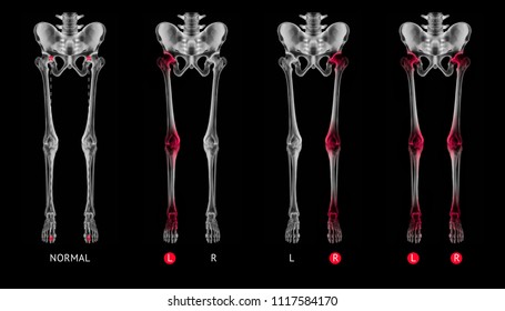 Alignment Types Disease Leg Bone Problem 스톡 일러스트 1114428761 | Shutterstock