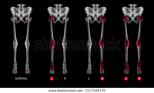 Xray Alignment Normal Leg Bone Neutral Stock Illustration 1117584170