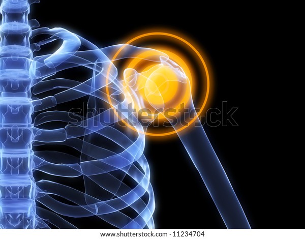Xray Shoulder Inflammation Stock Illustration 11234704