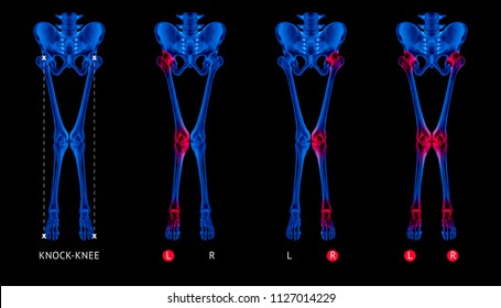 Xray Valgus Leg Alignment Knock Knee Stock Illustration 1127014229 ...
