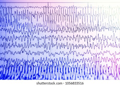 Abnormal Eeg Wave Formabnormal Eegbrain Wave Stock fotografie ...