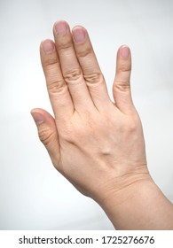 Abnormal Finger Alignment Due Dislocated Finger Stock Photo 1725276676 ...