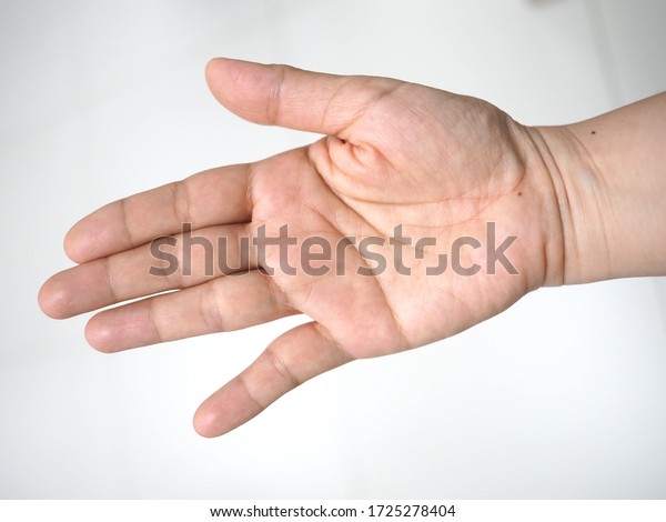 Abnormal Finger Alignment Due Dislocated Finger Stock Photo 1725278404 ...