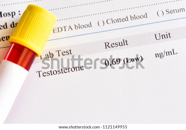 Abnormal Low Testosterone Hormone Test Result Stock Photo (Edit Now ...