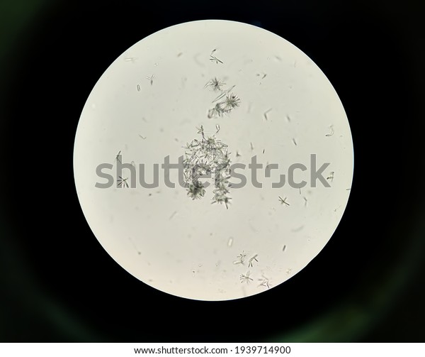 Abnormal Result Urinalysis Microscopic Method Under Stock Photo (Edit ...
