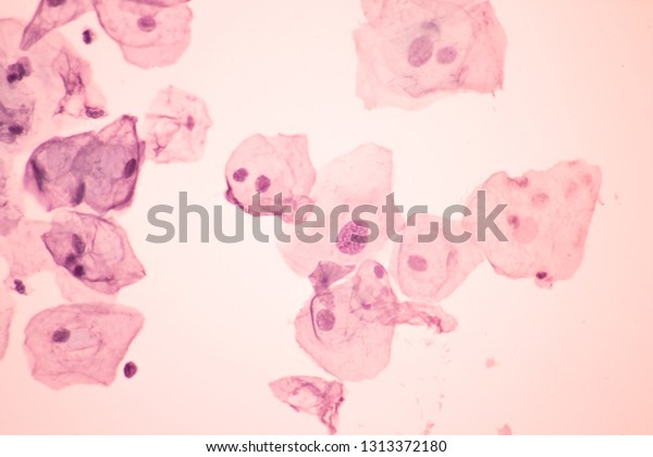 Abnormal Squamous Epithelial Cells View Microscopy Stock Photo (Edit ...