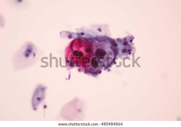 Abnormal Squamous Epithelial Cells View Microscopy Stock Photo ...
