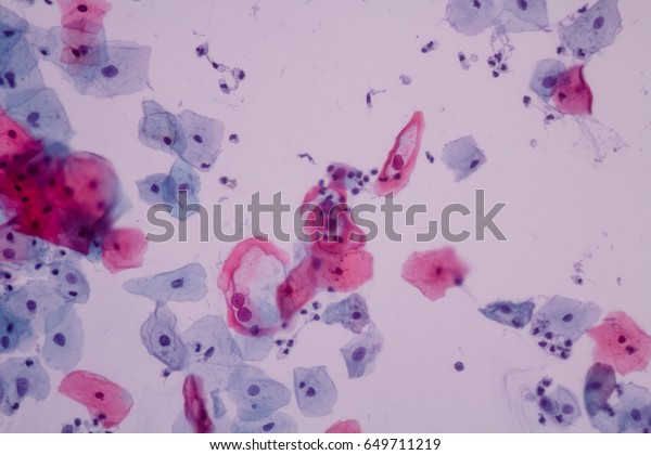 Abnormal Squamous Epithelial Cells View Microscopy Stock Photo (Edit ...