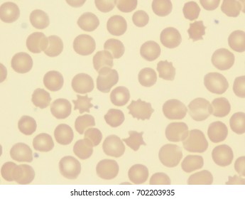 Acanthocyte : images, photos et images vectorielles de stock | Shutterstock