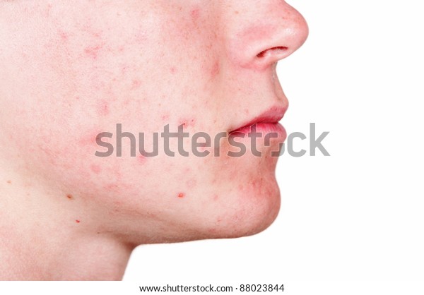 Acne Stock Photo 88023844 | Shutterstock
