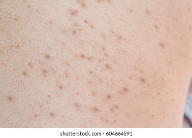 Mens Back Covered Red Rash Acne Foto Stok 1659910135 | Shutterstock