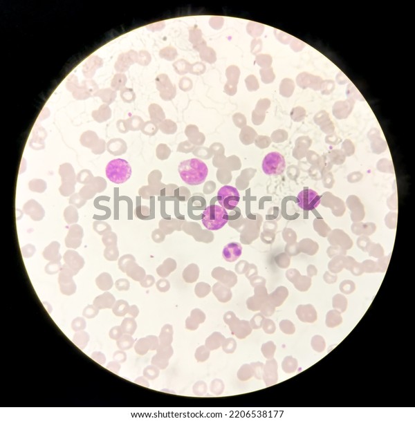 Acute Myeloid Leukemia Aml Cells Analysed库存照片2206538177 | Shutterstock Acute Myeloid Leukemia Aml Cells Analysed库存照片2206538177 | Shutterstock