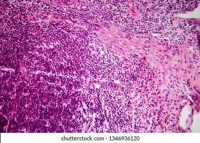 Acute Simple Appendicitis Light Micrograph Photo ภาพสต็อก 1346936120 ...