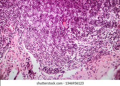 Acute Simple Appendicitis Light Micrograph Photo Stock Photo 1346936123 ...