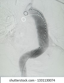 126 Endovascular stent graft Images, Stock Photos & Vectors | Shutterstock