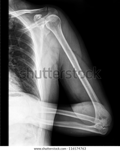 Arm Xray Stock Photo 116574763 | Shutterstock