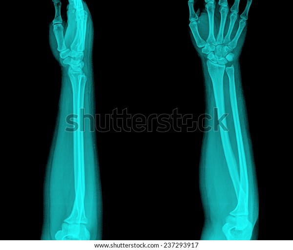 Arm Xray Two Position Stock Photo 237293917 | Shutterstock