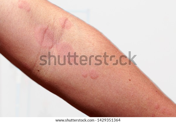 Around Arm Men Dermatitis Problem Rash Stock Photo 1429351364 ...