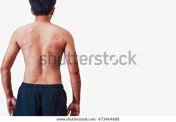 Around Back Men Dermatitis Problem Rash 스톡 사진(지금 편집) 673464688