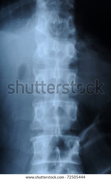 Authentic Xray Picture Human Backbone Stock Photo 72505444 | Shutterstock