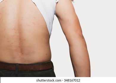 Back View Man Dermatitis Problem Rash Foto Stok 348167012 | Shutterstock