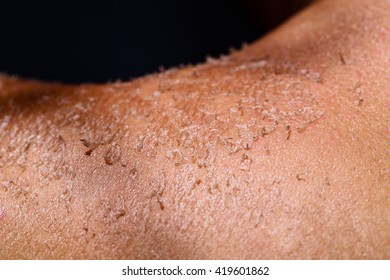 Back View Man Dermatitis Problem Itchy Stock Photo (Edit Now) 419601862