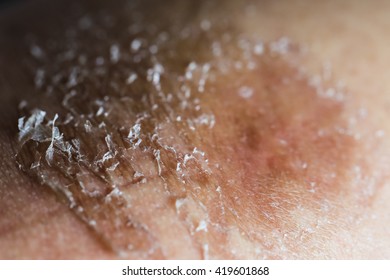 Back View Man Dermatitis Problem Itchy 스톡 사진 419601868 | Shutterstock
