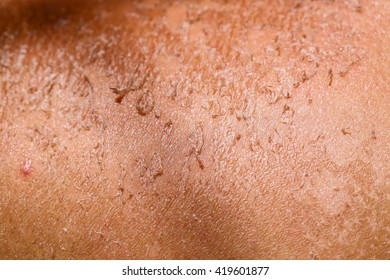 Back View Man Dermatitis Problem Itchy Stock Photo 419601877 | Shutterstock