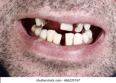 Bad Teeth Stock Photo 486229747 | Shutterstock