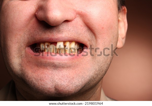 Bad Teeth Stock Photo (Edit Now) 219801964
