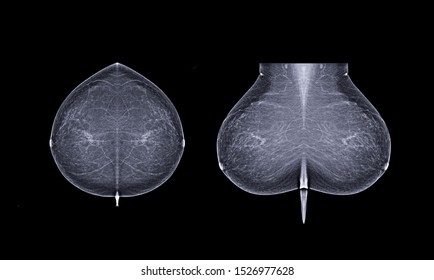 Basic Position Xray Digital Mammogram Both Stockfoto 1526977628 ...
