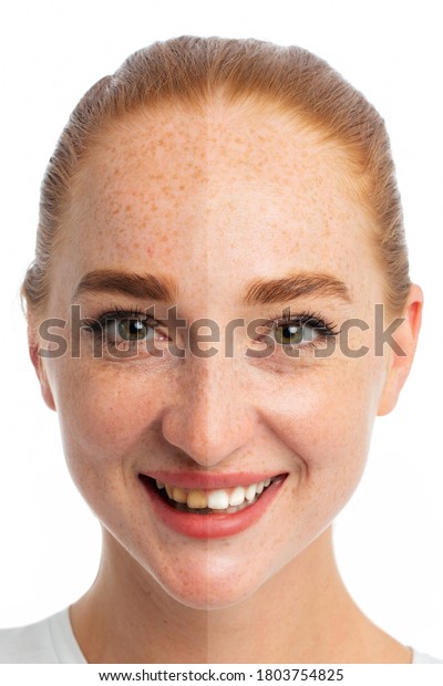 Before After Concept Model Bad Tooth Stock Photo 1803754825 | Shutterstock