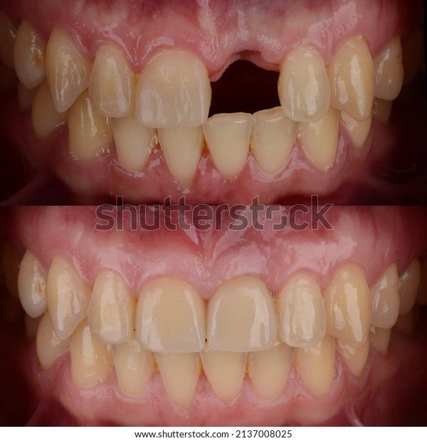 Стоковая фотография 2137008025: Before After Fixed Type Denture On ...