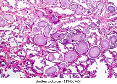 Benign Prostatic Hyperplasia Micrograph Shows Dilated Stock Photo ...