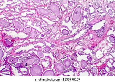 Benign Prostatic Hyperplasia Micrograph Shows Dilated Stock Photo ...