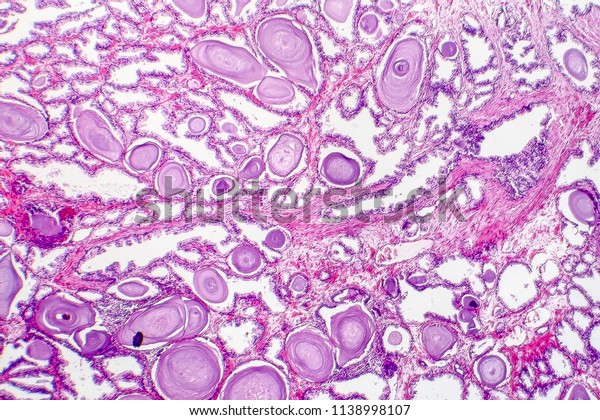 Benign Prostatic Hyperplasia Micrograph Shows Dilated Stock Photo ...