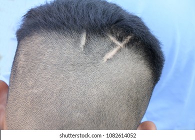 8,957 Scar On The Head Images, Stock Photos & Vectors | Shutterstock