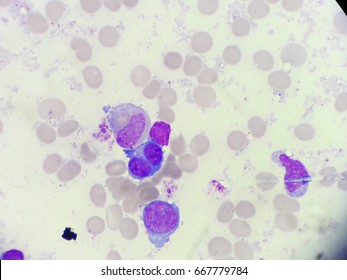 Blast Cells Peripheral Blood Smear Stock Photo (Edit Now) 1813535440