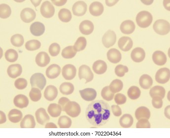 Myelodysplastic Syndrome Showing Dimorphic Red Cell Stock Photo (Edit ...